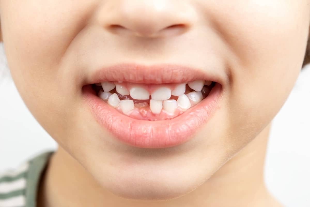 Dental Implants: Your Missing Tooth Solution
