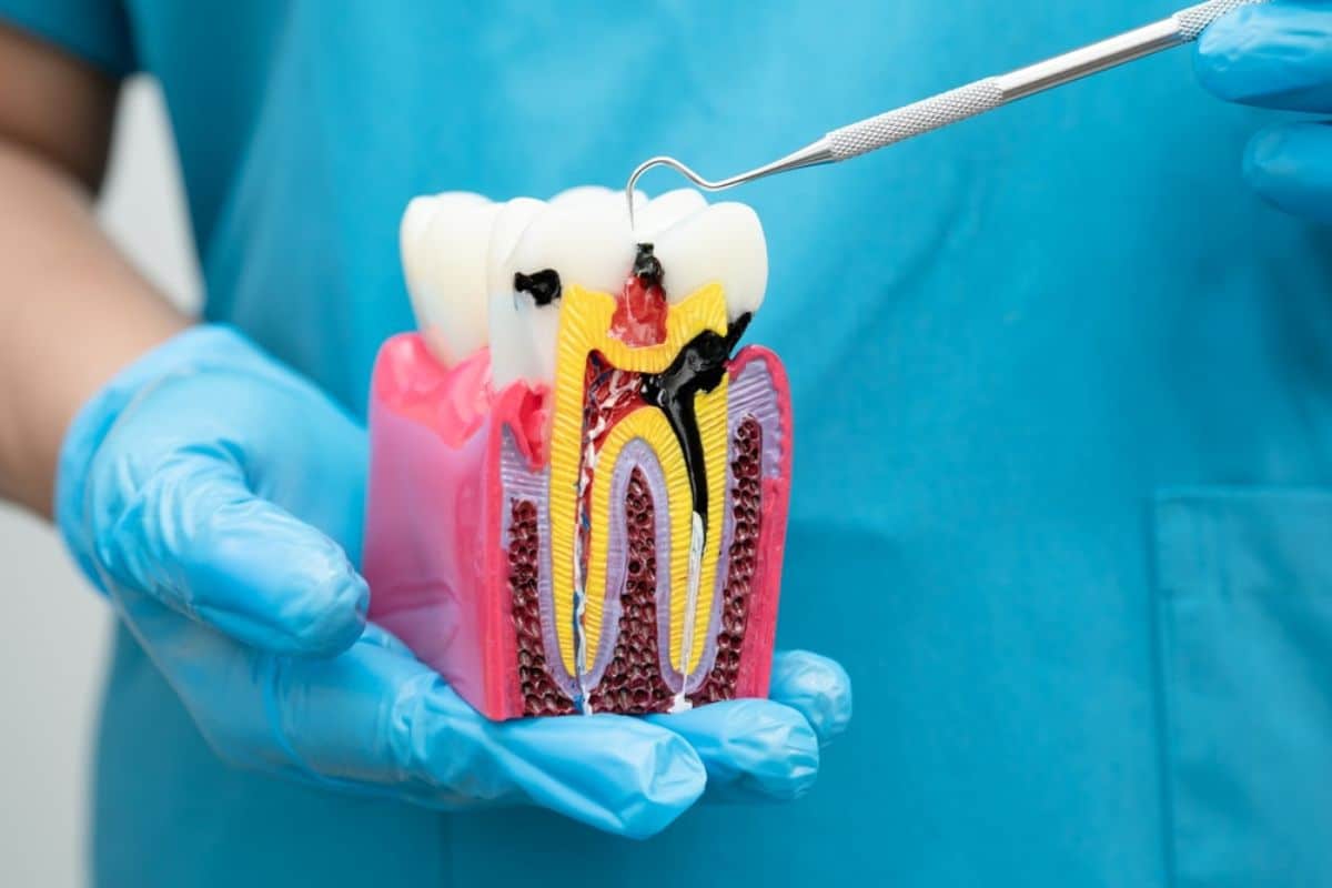 How Root Canal Can Save Your Natural Teeth | Powers Dental Group
